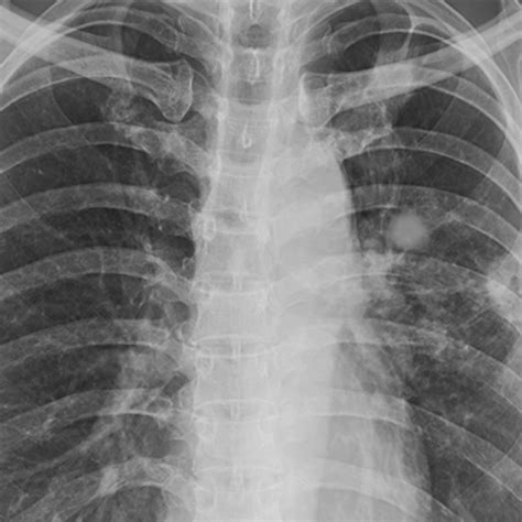 Exame De Nódulo De Pulmão Em Joinville Santa Catarina Médico Cirurgião Torácico