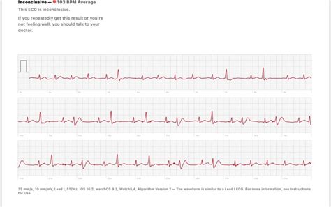 Multifocal Pvcs Or Pacs And Pvcs Rreadmyecg