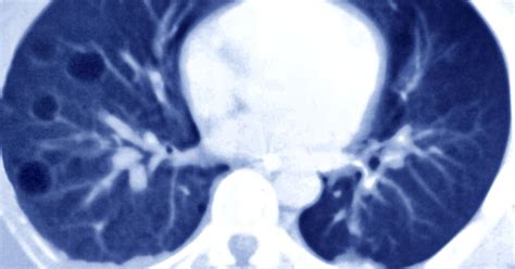 Mutated Dna Restored To Normal In Gene Therapy Advance The New York Times