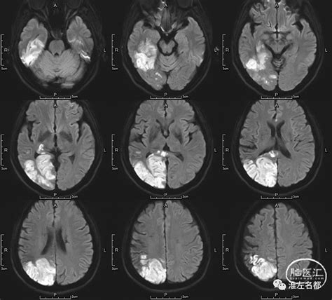 脑血管影像案例（36）：消化道出血 贫血引发颅内多血管闭塞患者大面积梗死 脑医汇
