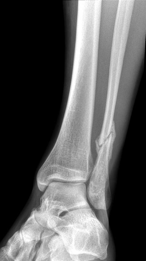 Fibula Fracture Ebnipod