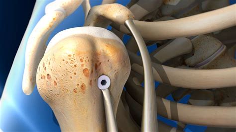 Biceps Tenodesis California Orthopaedic Specialists