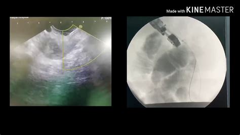 Eus Guided Gastrojejunostomy Direct Technique Twfc Youtube