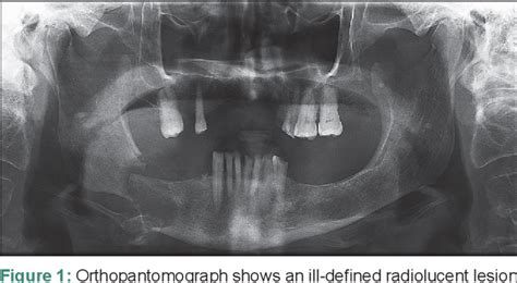 Figure 1 From Mandibular Metastasis In A Patient With Undiscovered Synchronous Thyroid And