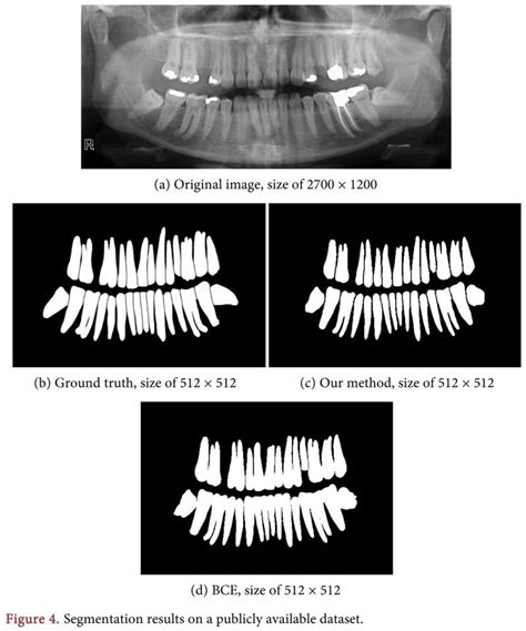 Scientific Research Publishing On Linkedin Panoramicxray Combinatorialloss Singletooth