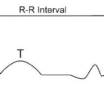 R R Interval For An ECG Exemplary Output Signal Download Scientific Diagram