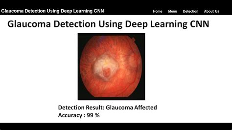 Glaucoma Detection Using Deep Learning Cnn Glaucoma Classification Using Python Project
