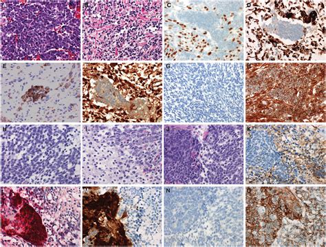 Medulloblastoma Pathology Outlines
