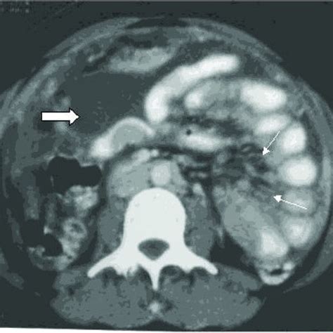 Dry Peritonitis Ct Scan Showing Diffuse Mesenteric Strands Mesenteric