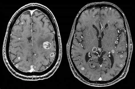 Brain Metastases Treatment A Stat3 Gene Inhibitor Discovered By Spanish Researchers Health