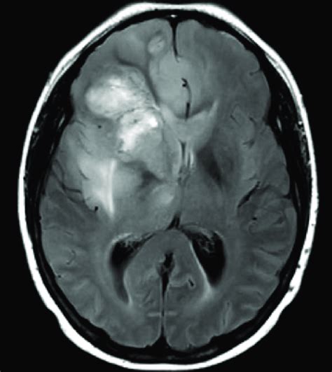 Axial Gradient Echo Gre Image Depicts Multiple Foci Of Hypointense