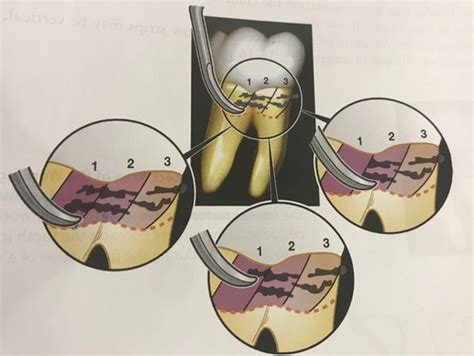 Module 16 Subgingival Calculus Removal Flashcards Quizlet