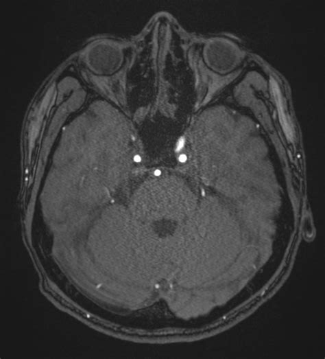Basal Ganglia Subacute Infarct Radiopaedia 80201 93521 Axial Mra Nc
