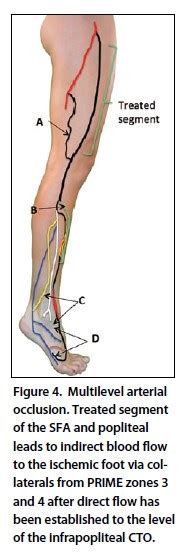 Angiosome Directed Therapy For The Cli Patient Endovascular Today