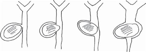 Csendez Classification Of Mirizzi Syndrome Download Scientific Diagram