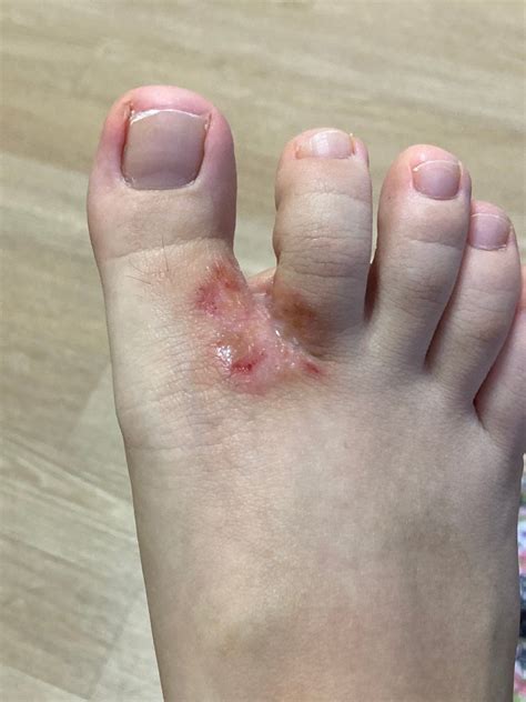 발 사이 간지러움 각질 갈라짐 지식in