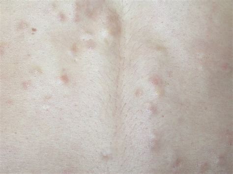 Subcutaneous Nodules On The Abdomen Ppt