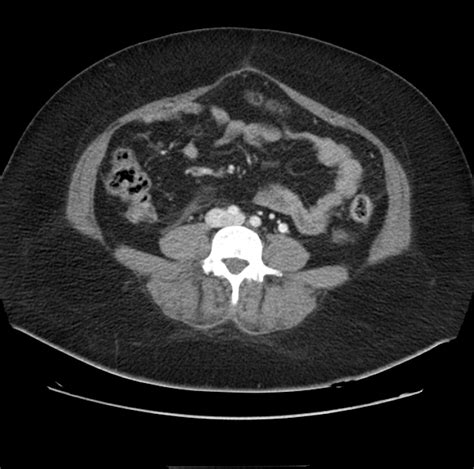 Acute Pancreatitis Balthazar E Radiopaedia 29016 29377 Axial C