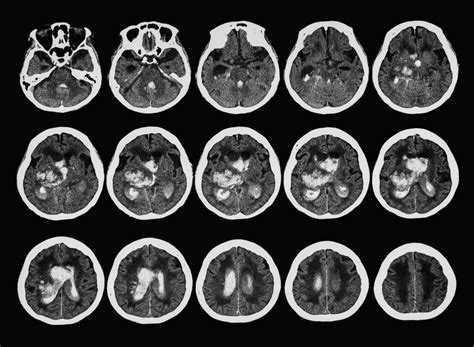 The Role Of Ct And Mr In Stroke Patients