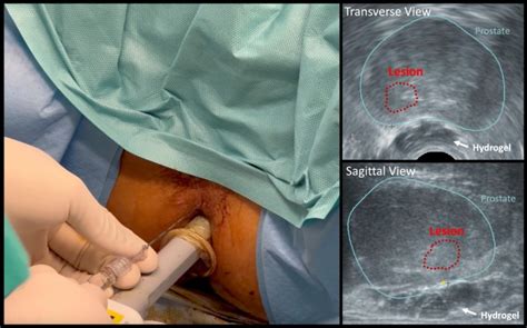 Cryotherapy For Posterior Lesions Of The Prostate The Hydrogel