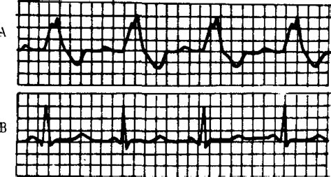 Q T间期延长 临床心电图学 医学