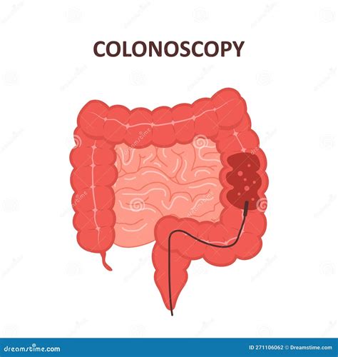 Colonoscopy Procedure Intestine Exam And Treatment Colon Polypectomy