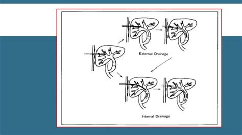 Ptc Percutaneous Transhepatic Cholangiography Pptx Digestive Disorders Diseases And