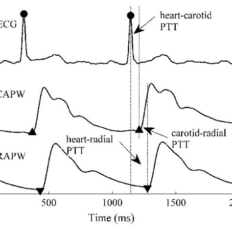 Simultaneously Measured Ecg Carotid And Radial Arterial Pulse Download Scientific Diagram