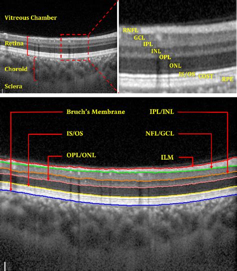 Figure 1 From Robust Retinal Layer Segmentation Using Oct B Scans A Novel Approach Based On