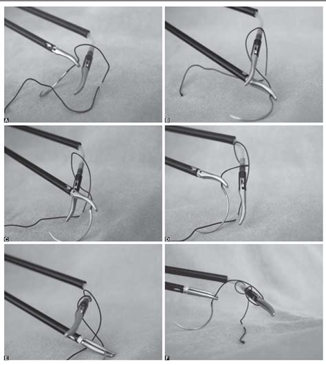 Figure 1 From Energy System And Endosuturing In Single Incision