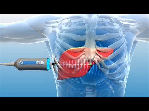 Fibroscan Ohio State Medical Center