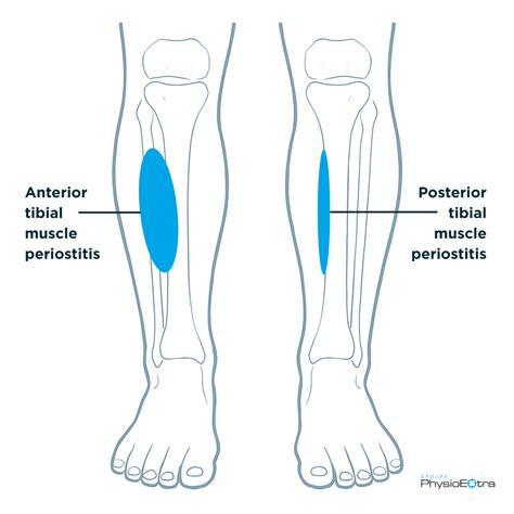How To Heal Anterior Shin Splints