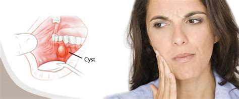 Cysts And Tumors Of Jaw Bones Top Oral Pathologist Gurgaon