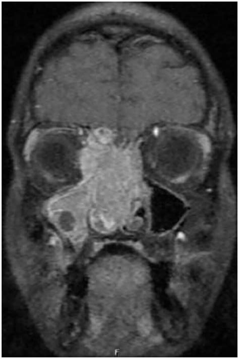 High Grade Sinonasal Small Cell Neuroendocrine Carcinoma In A Patient