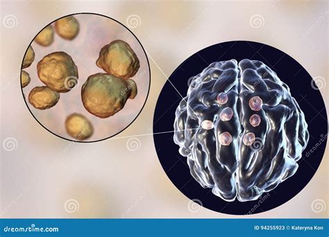 Multiple Cryptococcal Cysts In Brain Stock Illustration Illustration Of Neoformans Cyst 94255923