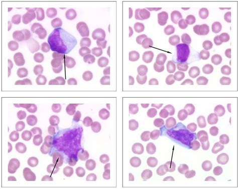 Reactive Lymphocytes Ematologia