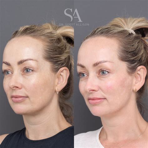 Cheek Filler Brisbane Boost Volume And Hydration