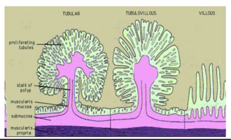 7 Disorders Of The Intestines Ii Flashcards Quizlet