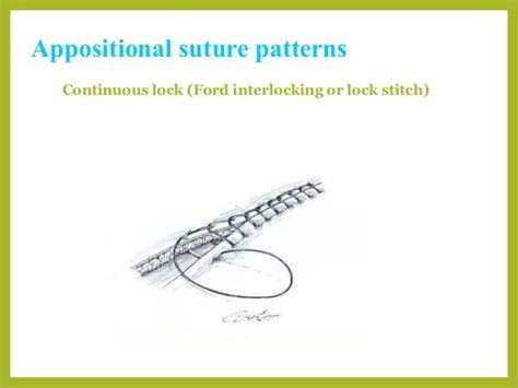 Basic Suture Patterns Tension And Interrupted Vertical Mattress