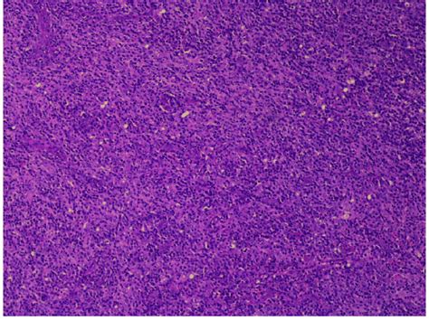 Lymph Node Biopsy Showing Effaced Architecture On 109 Resolution Download Scientific Diagram