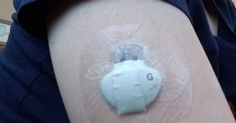 Medtronic Cgm Sensor Insertion Sensor Education Blog Medtronic Cgm Sensor Insertion Sensor Education Blog