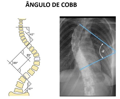 Escoliose Quais São Os Principais Sinais Clínicos