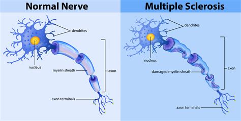 Normal Nerve And Multiple Sclerosis 294059 Vector Art At Vecteezy