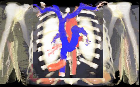 Juxtaposition Of Skeletons And Volumes For Focus Context Visualization Download Scientific