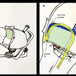 Intraoperative View Posterolateral And Retrosigmoid Routes The Second Download Scientific