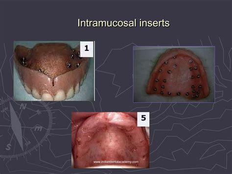 Classification And Impression Techniques Of Implantsprosthodontic