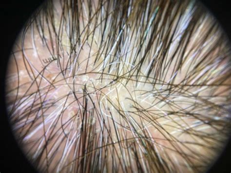 Video What Is Lichen Planopilaris Aka Lpp Dr U Hair And Skin Clinic Fue Hair Restoration Video What Is Lichen Planopilaris Aka Lpp Dr U Hair And Skin Clinic Fue Hair Restoration