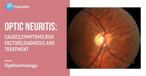 Neuritis Disease Signs Differentiating Typical From Atypical Optic