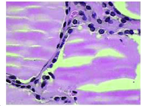 Microscopy Of Goiter Showing No Signs Of Goiter Malignancy Download Scientific Diagram