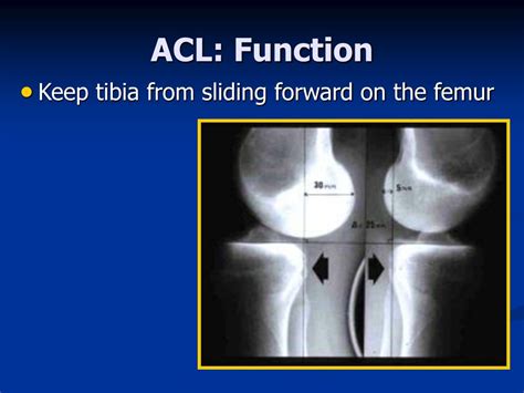 Ppt Acl Prevention Powerpoint Presentation Free Download Id137086